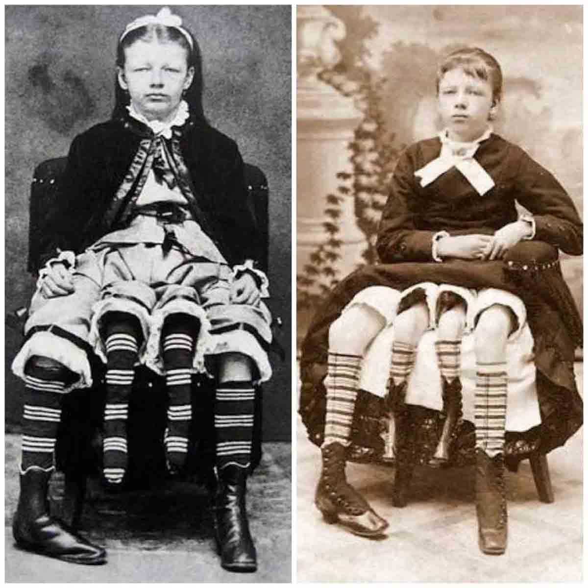 myrtle corbin | నాలుగు కాళ్లు.. రెండు జ‌న‌నేంద్రియాలు.. ఆమె పుట్టుక ...