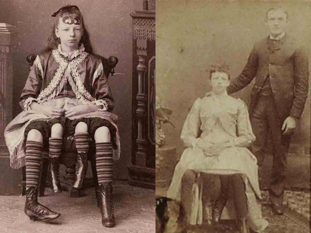 myrtle corbin | నాలుగు కాళ్లు.. రెండు జ‌న‌నేంద్రియాలు.. ఆమె పుట్టుక ...