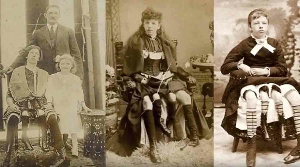 myrtle corbin | నాలుగు కాళ్లు.. రెండు జ‌న‌నేంద్రియాలు.. ఆమె పుట్టుక ...
