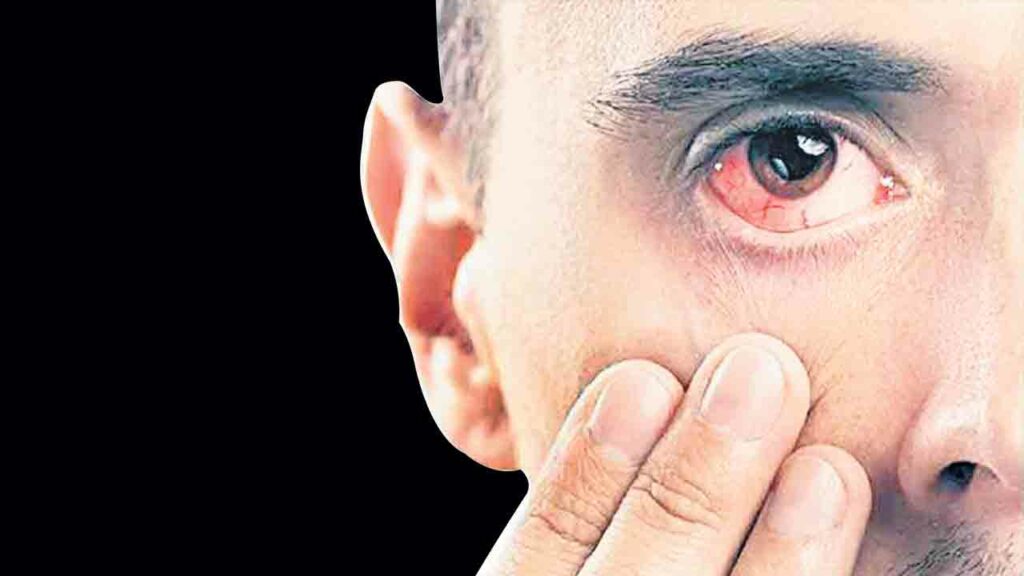 Pink Eye | కండ్ల కలక ఎలా వస్తుంది? ఇది రాకుండా ఎలాంటి జాగ్రత్తలు ...